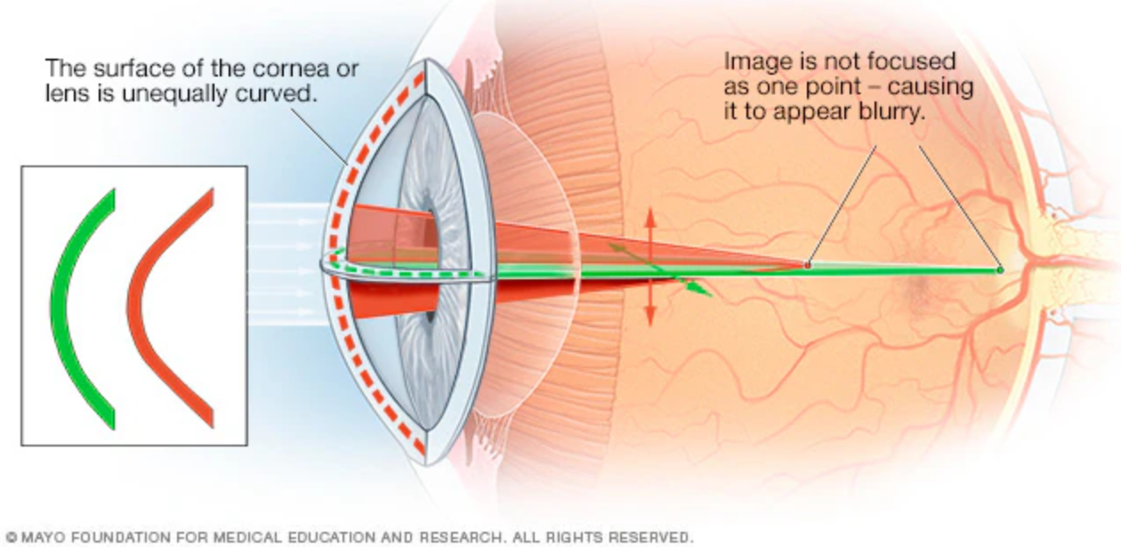 Astigmatism | Eyesights